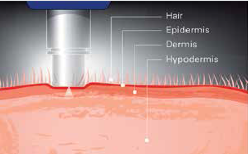IDAL Intradermal Vaccination - MSD Animal Health United Kingdom